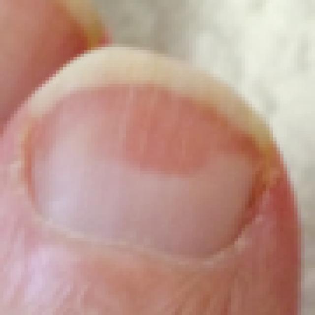 Nail Disease Detection Object Detection Dataset (v6, 2022-11-13 11:10pm ...