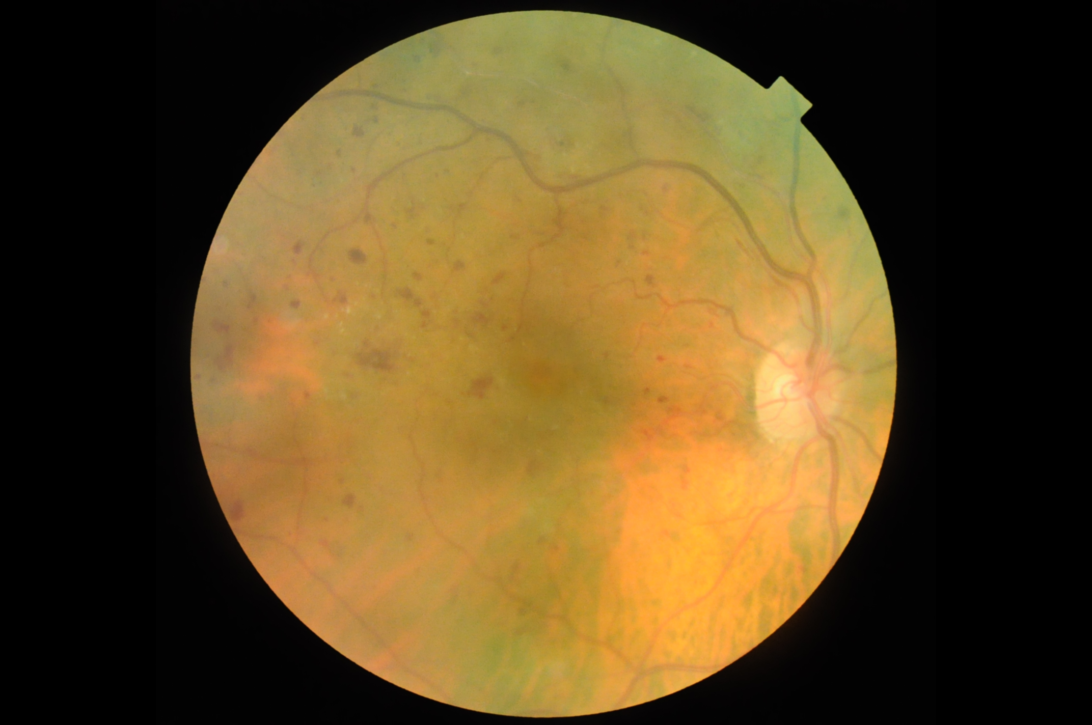 Retinal Images 2 Classification Model by training