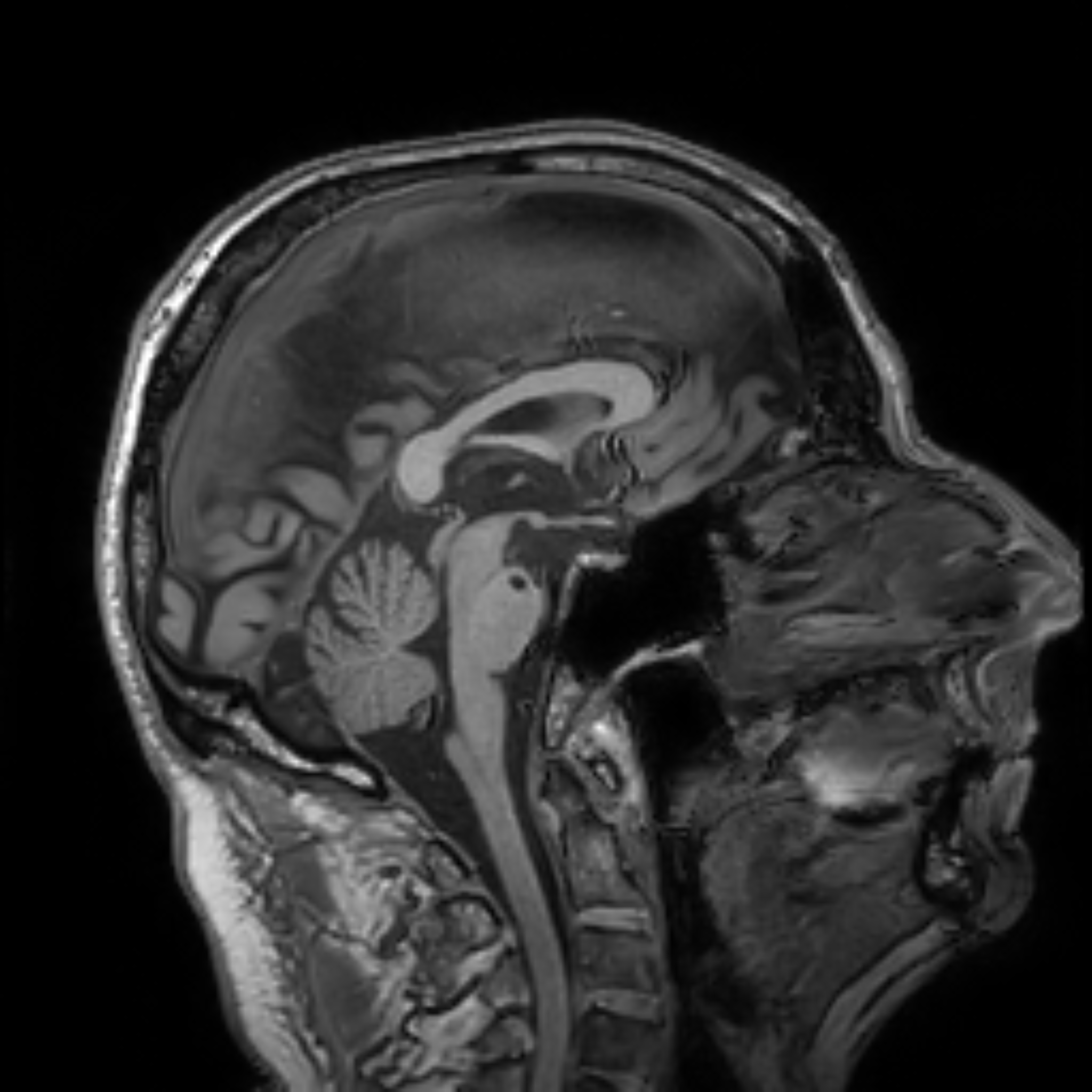 ParkinsonsDetection_MRI 2 Instance Segmentation Model by Eshan Shukla