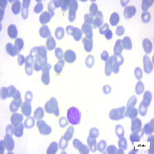 Leukemia Cancer Detection Object Detection Dataset and Pre-Trained Model by KAUST