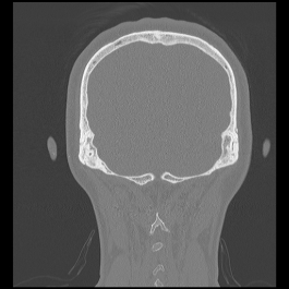 Inferior Turbinate CT Instance Segmentation Model by ENS interfere nasal