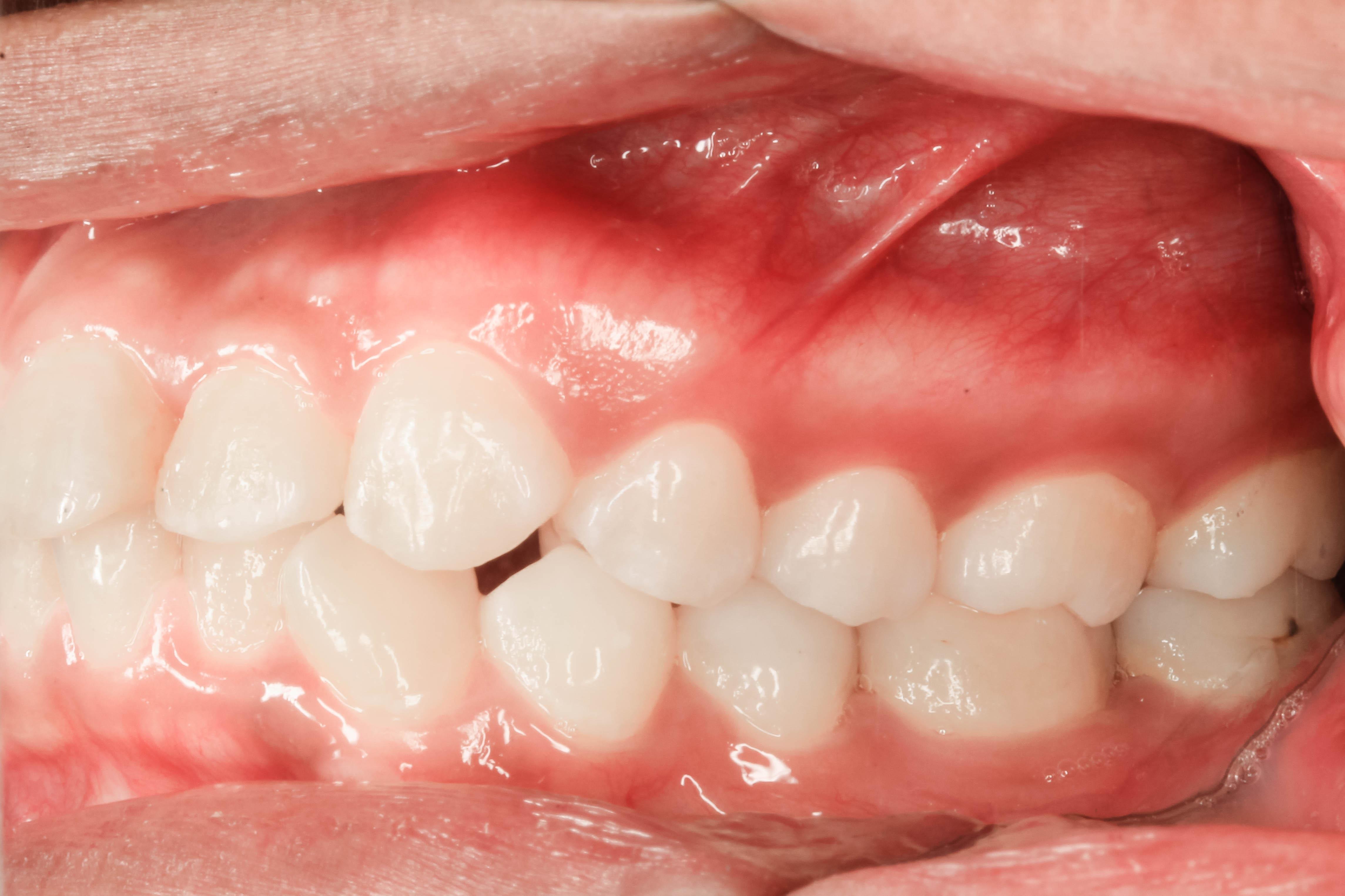 Tooth Caries 2 Object Detection Dataset by YOLO v8 training