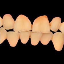 Tooth Caries 3 Object Detection Dataset by YOLO v8 training