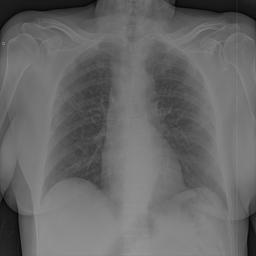 cxr Object Detection Model by abhijit