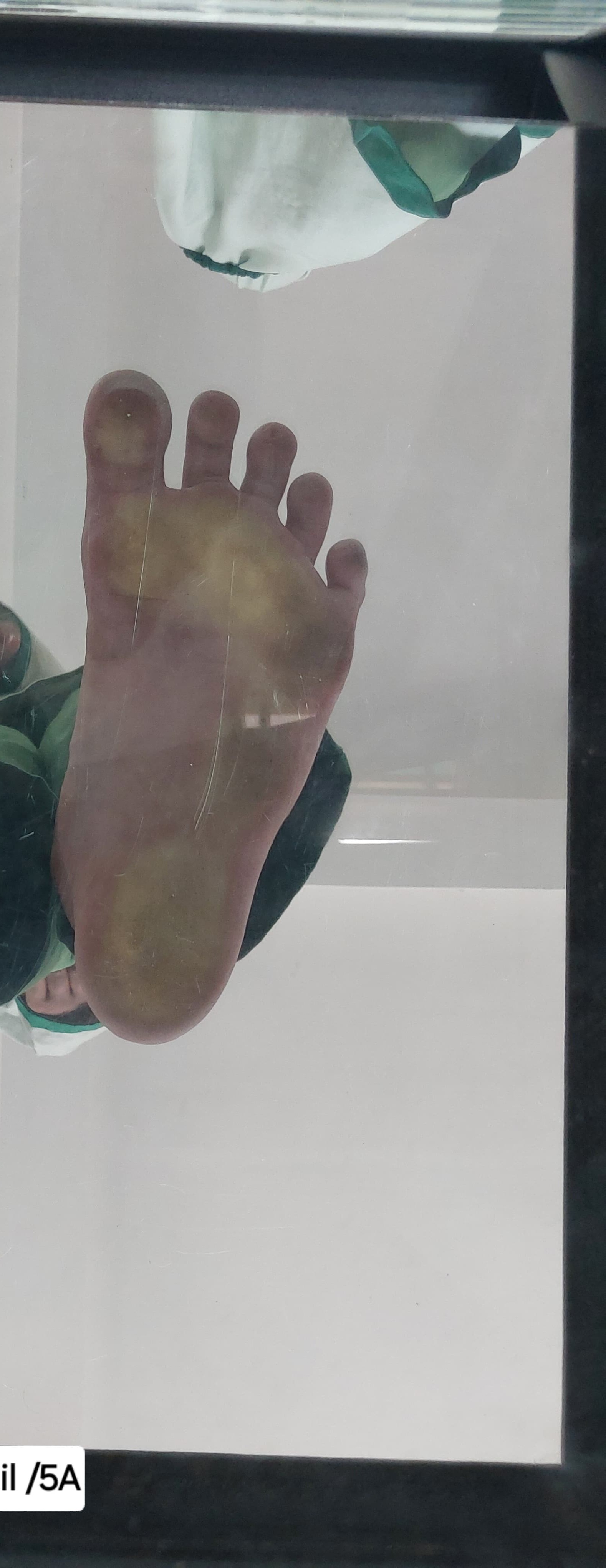 Clarke's Angle for Foot Keypoint Detection Model by EL GANADOR