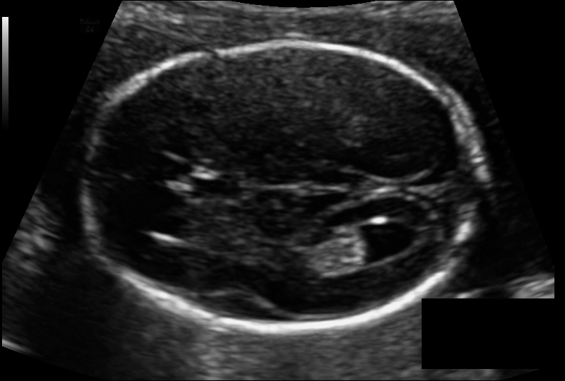 Ultrasound Fetal Brain image detection Object Detection Model by Firaas ...