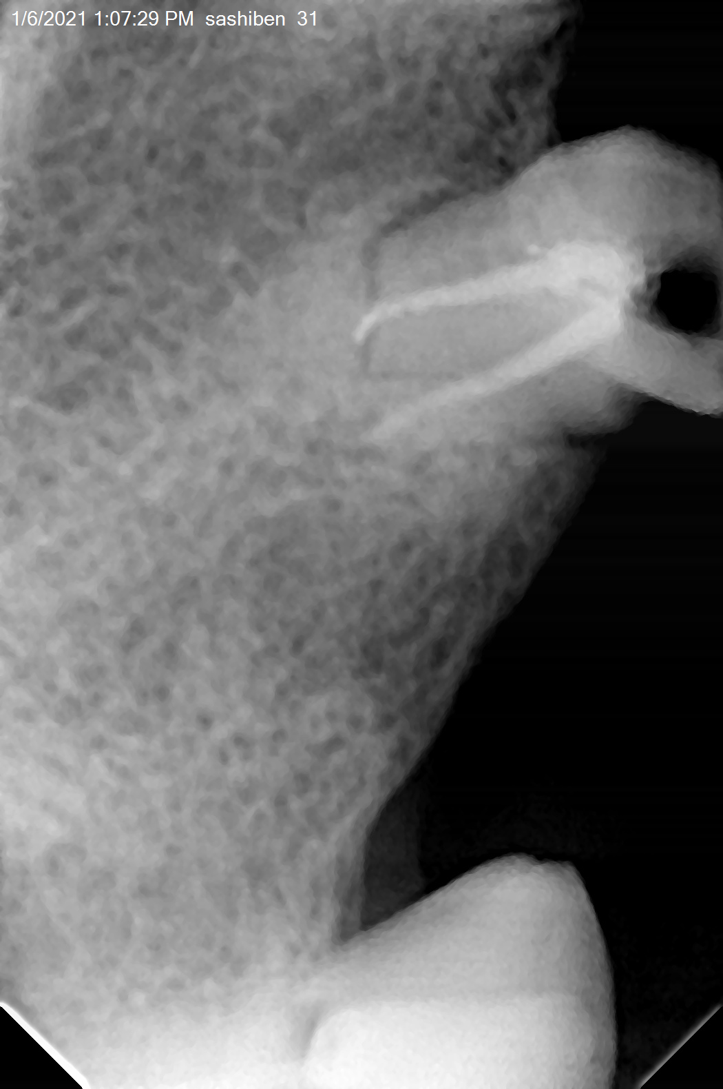 Cavity Detection Object Detection Model By Caries Detection 1