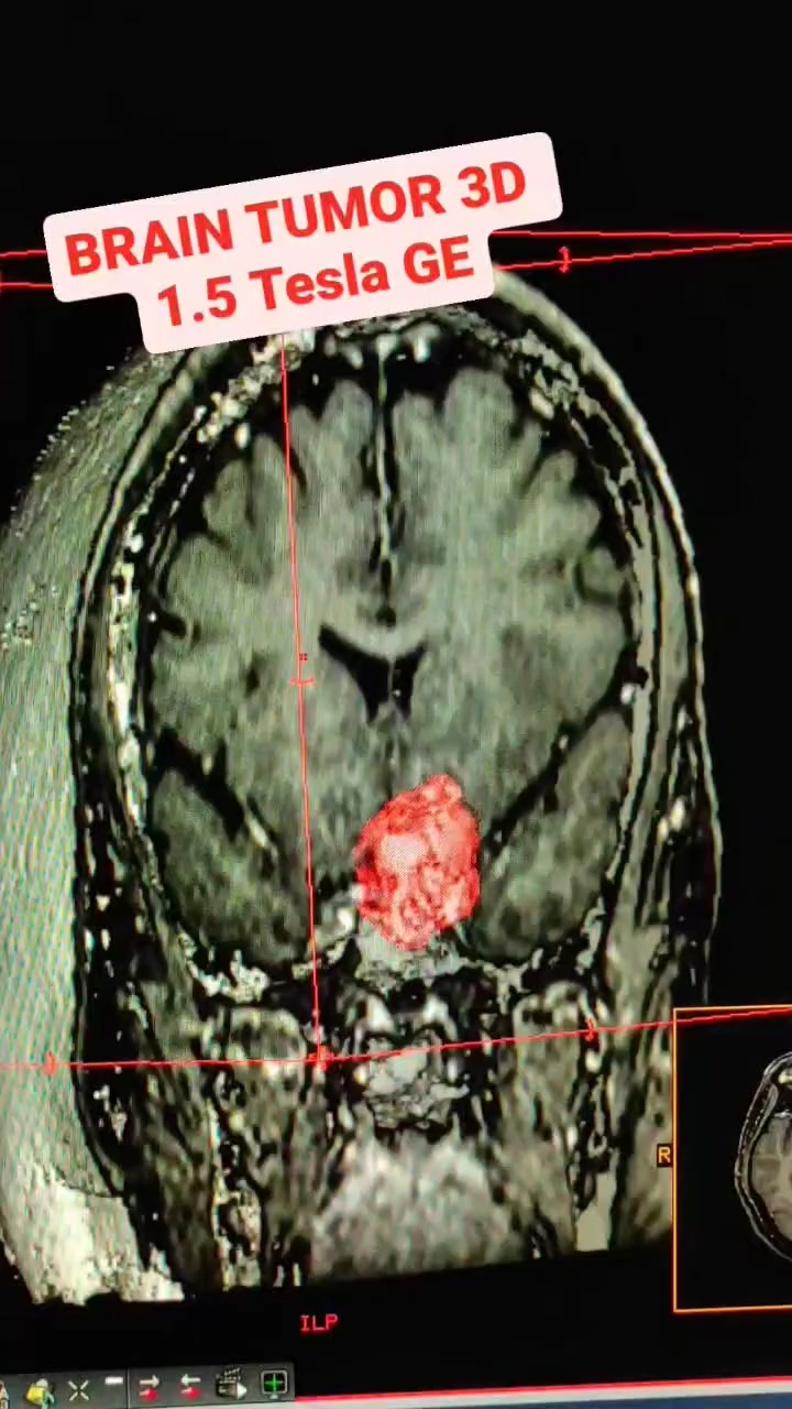 brain Object Detection Model by Anjali
