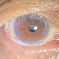 Cataract Sample Classification Dataset by Image Katarak