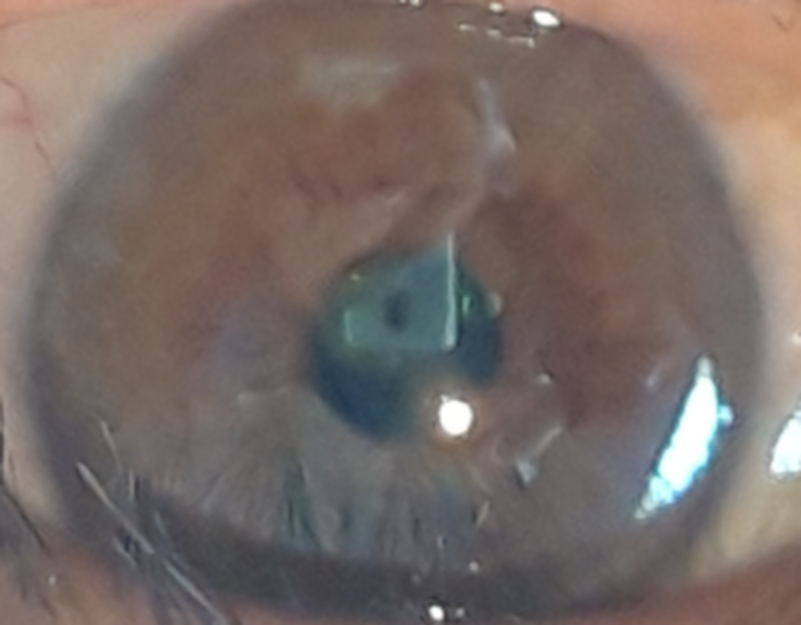 iris-mata Classification Dataset by cornea