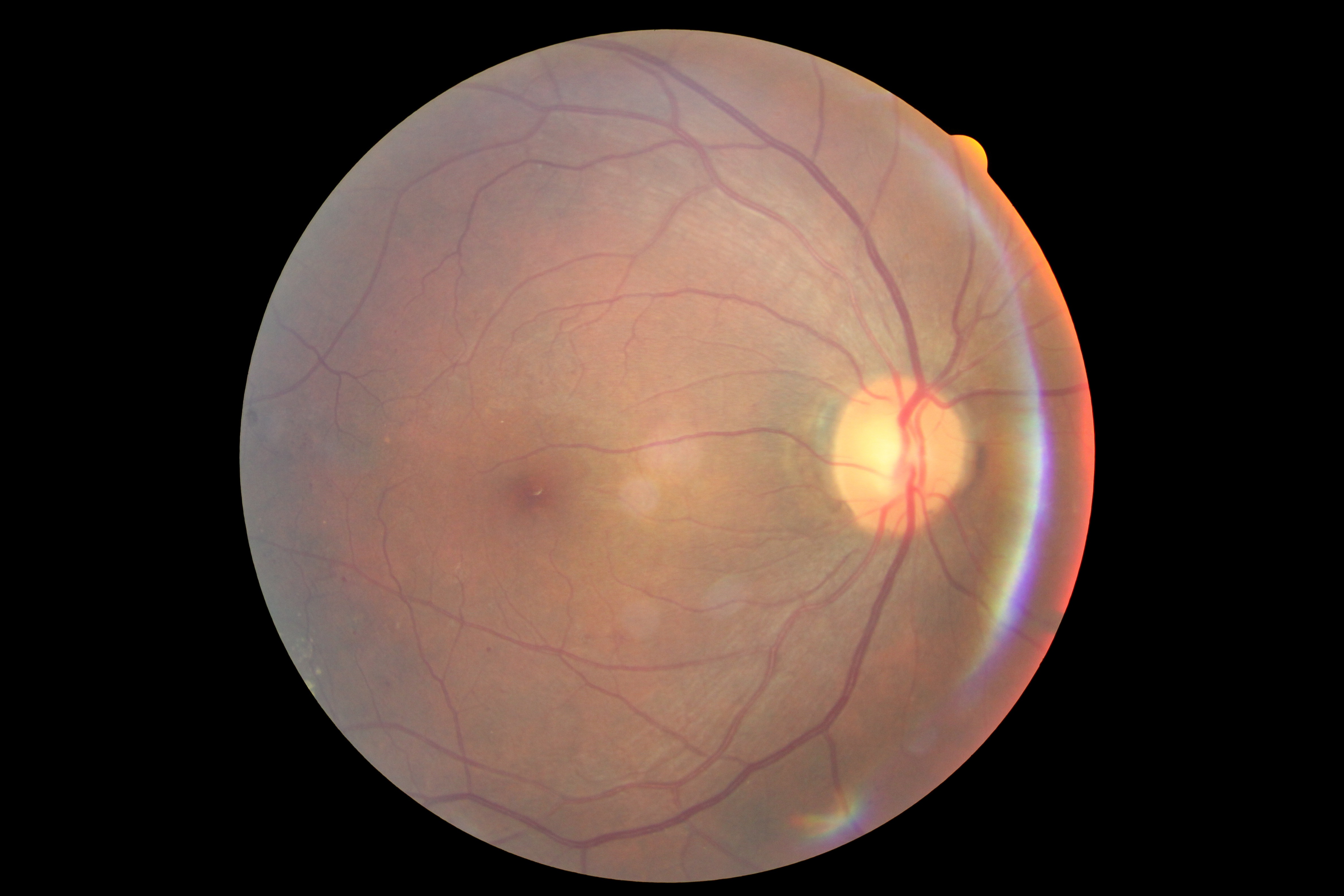 diabetic_retinopathy Classification Dataset by HackBoats