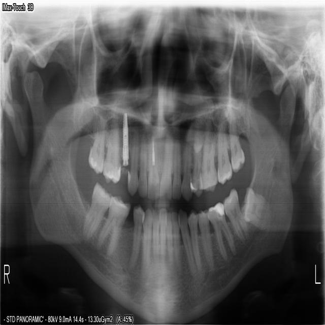 Dental X-Ray-3 Instance Segmentation Dataset by Medical