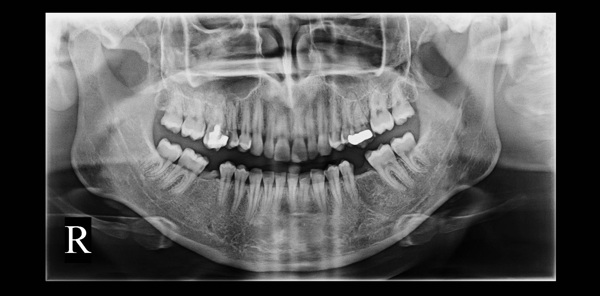 periapical Instance Segmentation Dataset by teeth disease detect