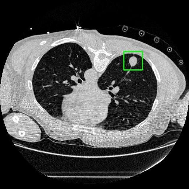 Lung Cancer Detection Object Detection Dataset By Imad Ahmad