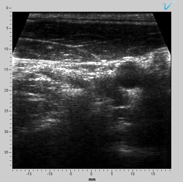 Artery Detection Instance Segmentation Dataset And Pre Trained Model By Speker