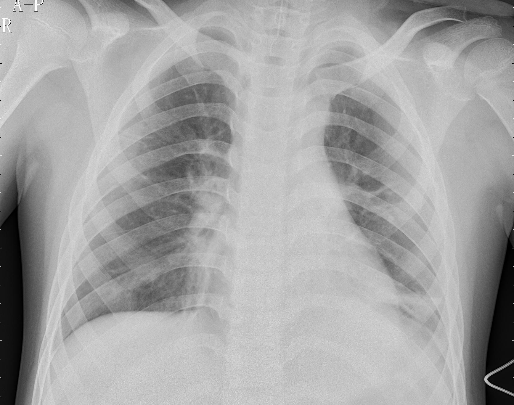 chest Classification Dataset by Khon Kaen University