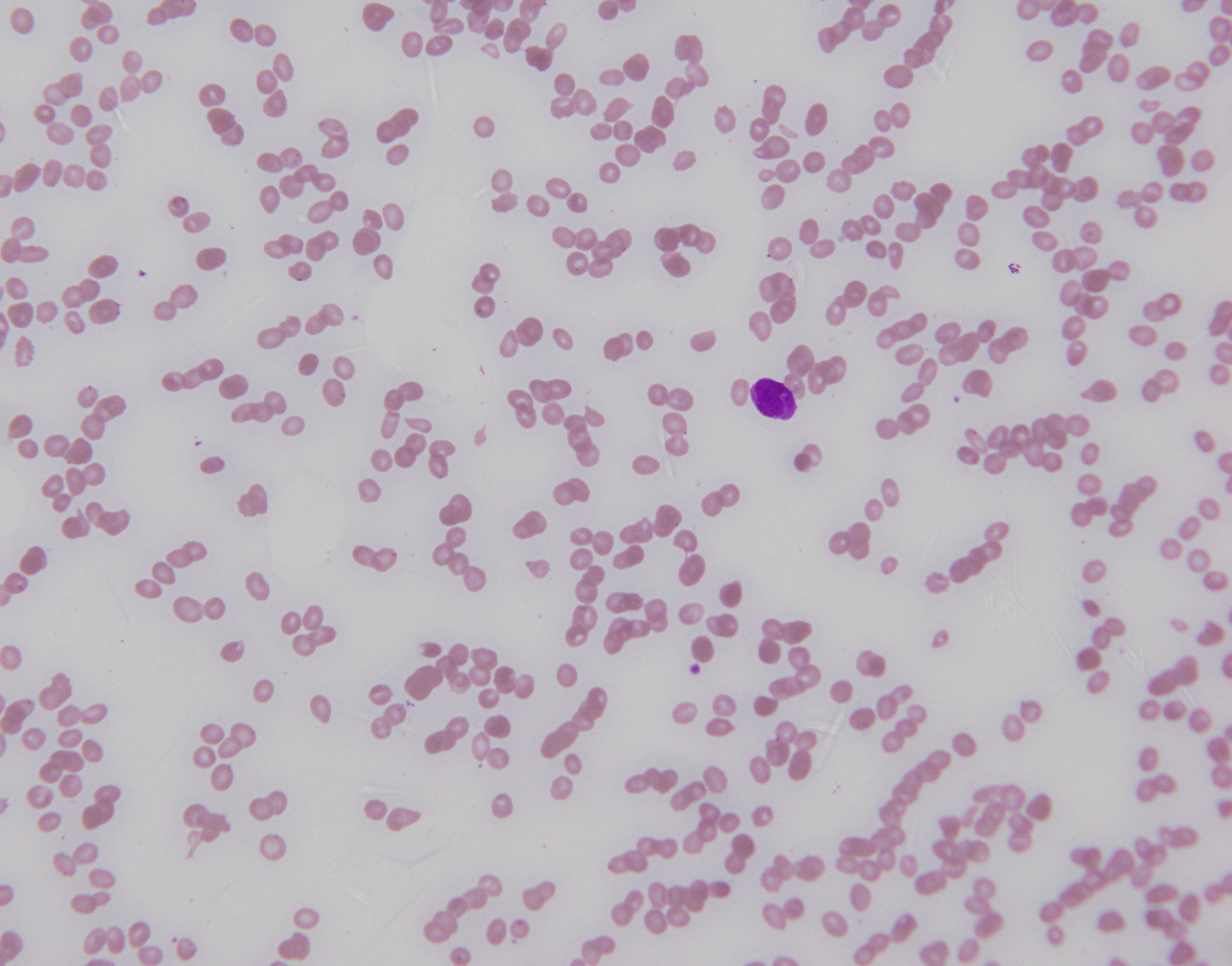 Leukemia-Detection2 Object Detection Model by Zheng