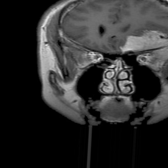 Mri Image Tumor Detection Object Detection Dataset And Pre Trained