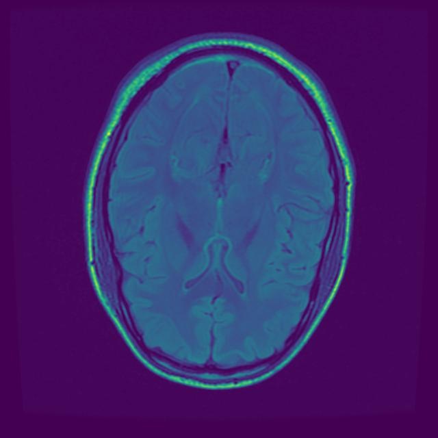 Brain Tumor Object Detection Dataset by ABHIJIT SINGH