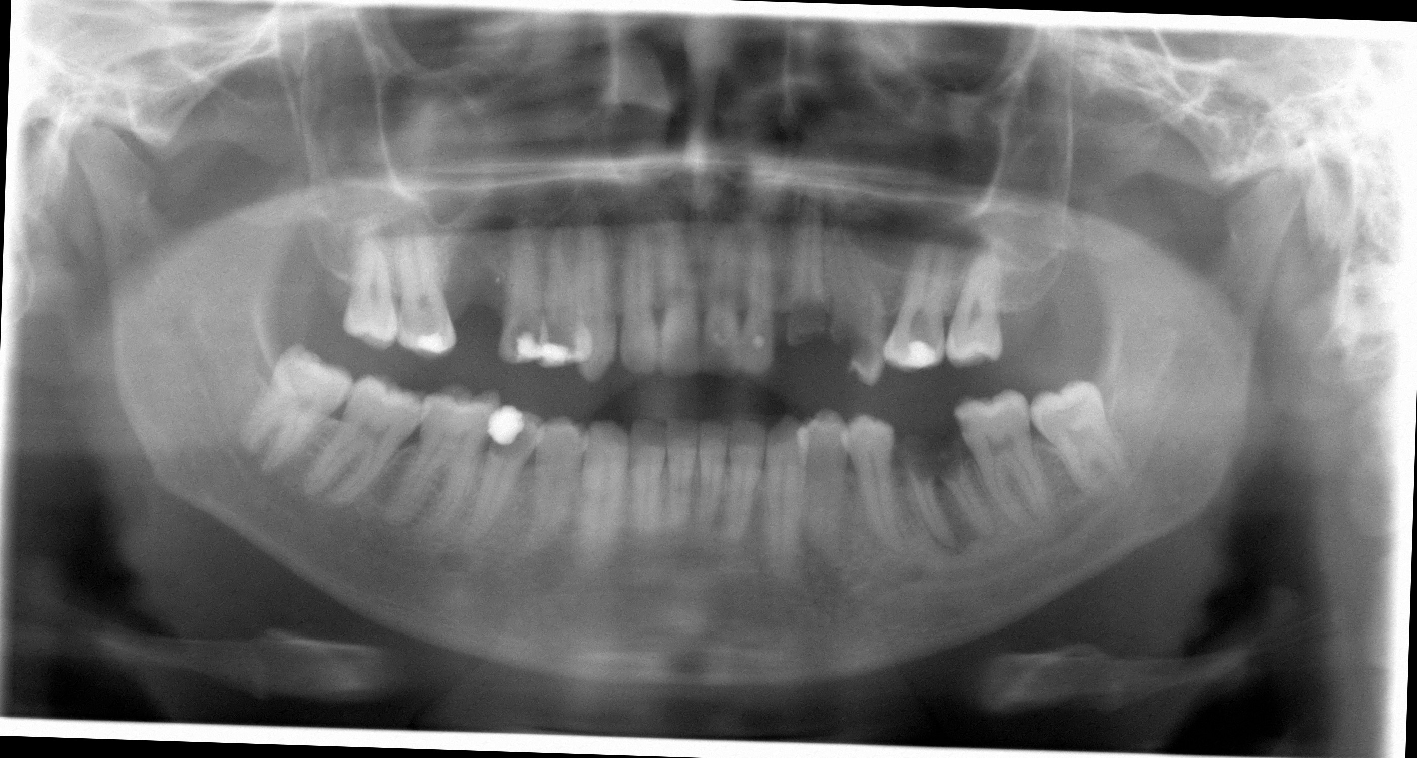 Teeth Object Detection Dataset By Dental Diseases Detection