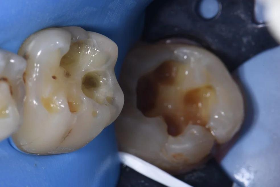 Data Teeth Instance Segmentation Dataset And Pre Trained Model By Tongyaya