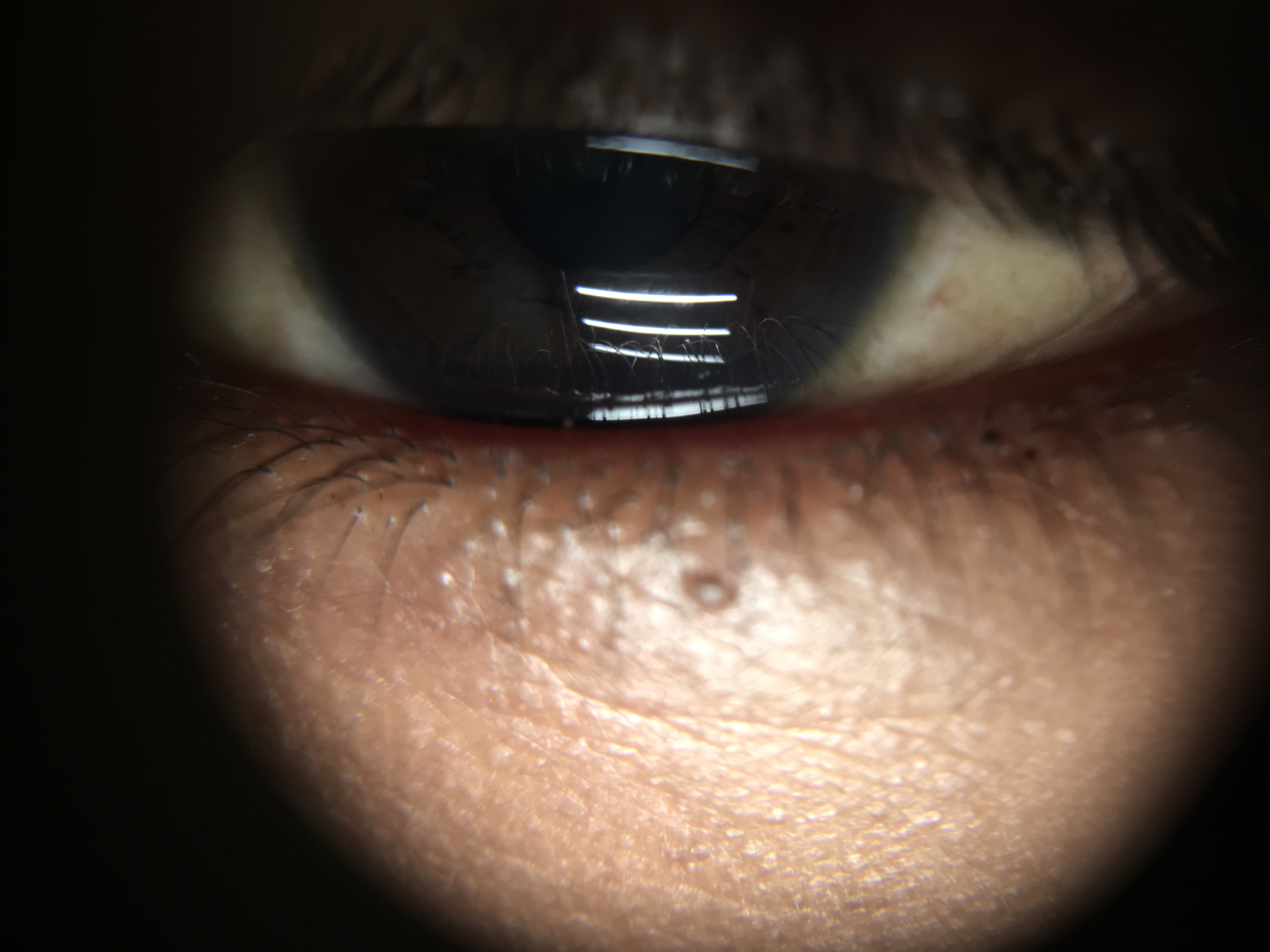 Dry Eye Disease Object Detection Dataset and Pre-Trained Model by Data