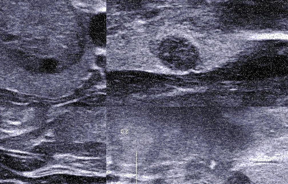Segmentcalcification Instance Segmentation Dataset And Pre Trained