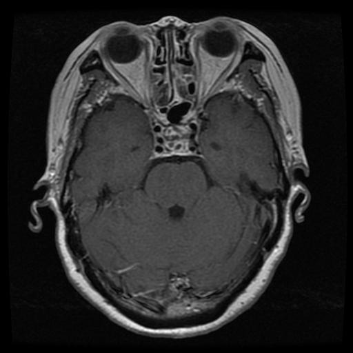 Meningiomas in MRIs Object Detection Dataset and Pre-Trained Model by Batch B Brilliant Butterflies