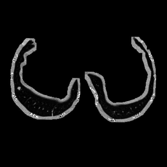 lung nodule detection using yolo v8 Object Detection Dataset by testCV