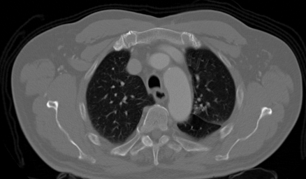 Ct scan Classification Model by student