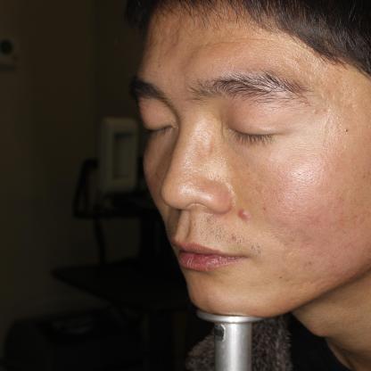 Skin Analysis Object Detection Dataset by facialanalysis