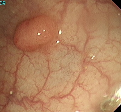 polyp detection Object Detection Dataset by hg