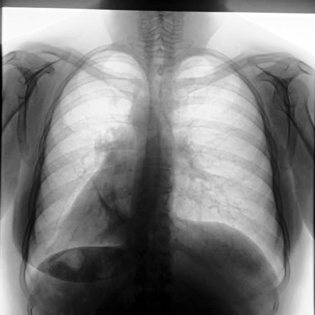Tuberculosis Detection Classification Model by Hamza