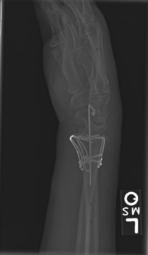 Bone Fracture Detection Object Detection Model (v2, 2025-05-14 10:26am ...