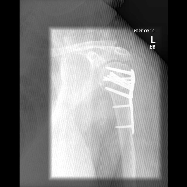 ShoulderValid Object Detection Dataset by Bone fracture detection