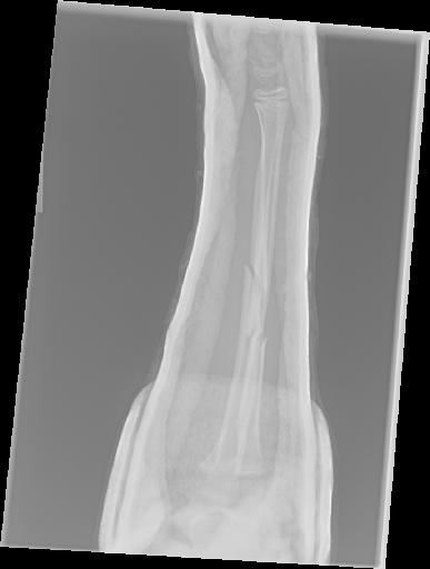 Forearm Object Detection Dataset by Bone fracture detection