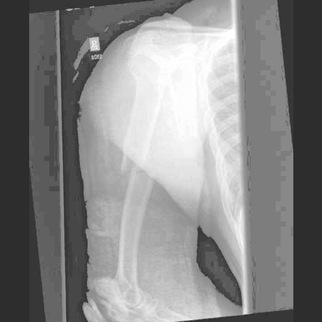 Validdataset Object Detection Dataset By Bone Fracture Detection