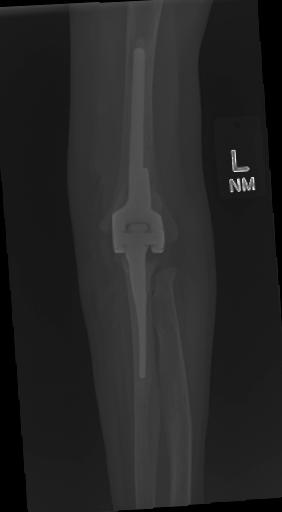 Elbow Object Detection Dataset by Bone fracture detection