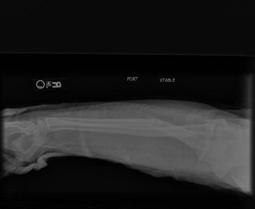 FracutreBoneALL Object Detection Dataset by Bone fracture detection
