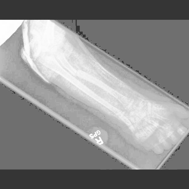 forearmValid Object Detection Dataset by Bone fracture detection