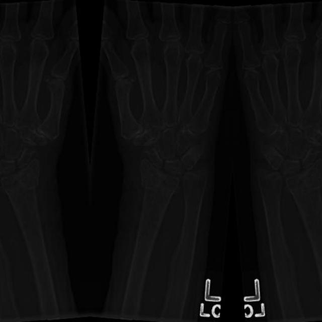 fingerValid Object Detection Dataset by Bone fracture detection