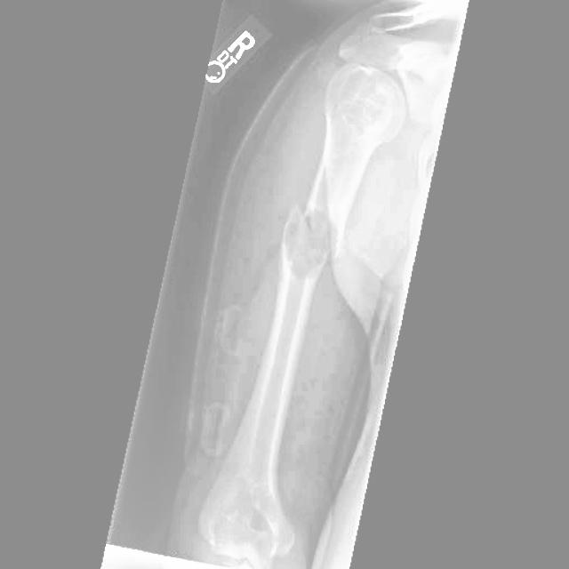 humerus Object Detection Dataset by Bone fracture detection