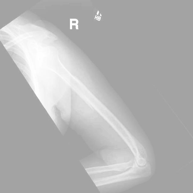 humerusValid Object Detection Dataset by Bone fracture detection