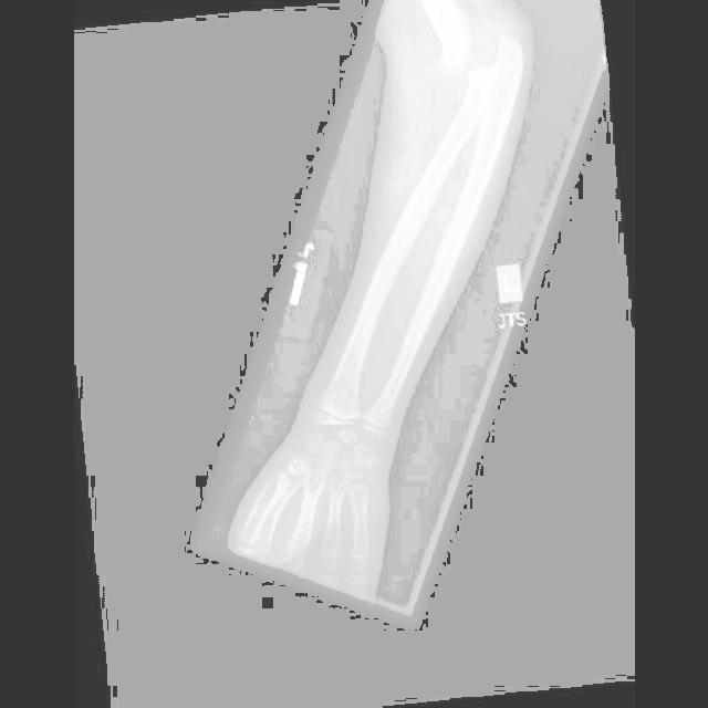 Fingerconfidence Object Detection Dataset By Bone Fracture Detection