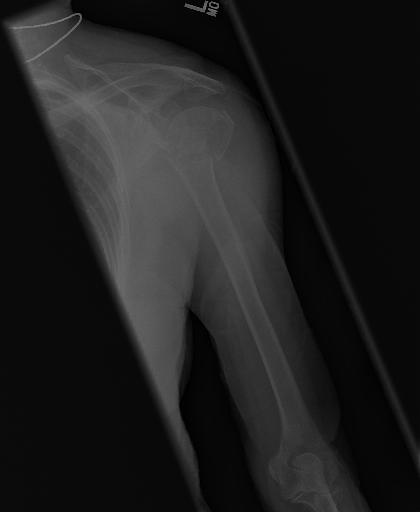 boneFractureALL85 Object Detection Dataset by Bone fracture detection