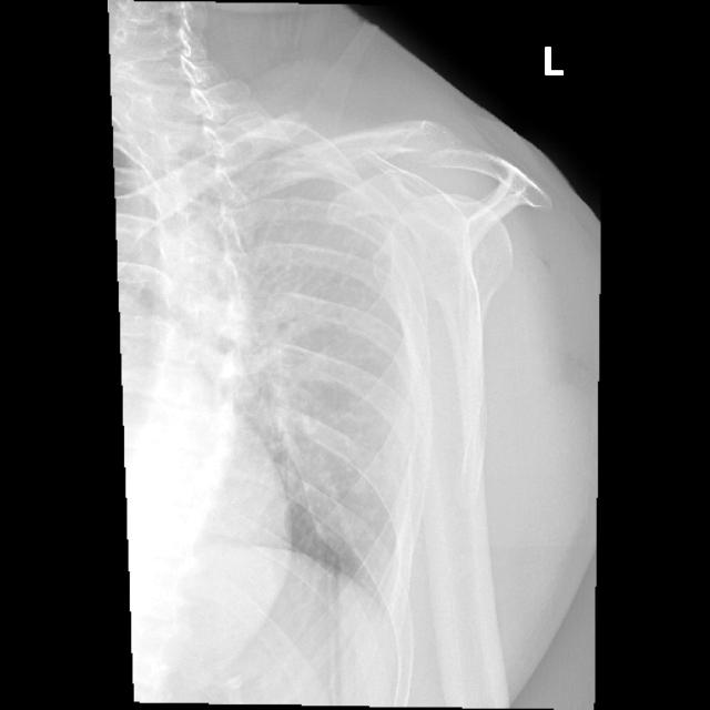 ShoulderAN Object Detection Dataset by Bone fracture detection