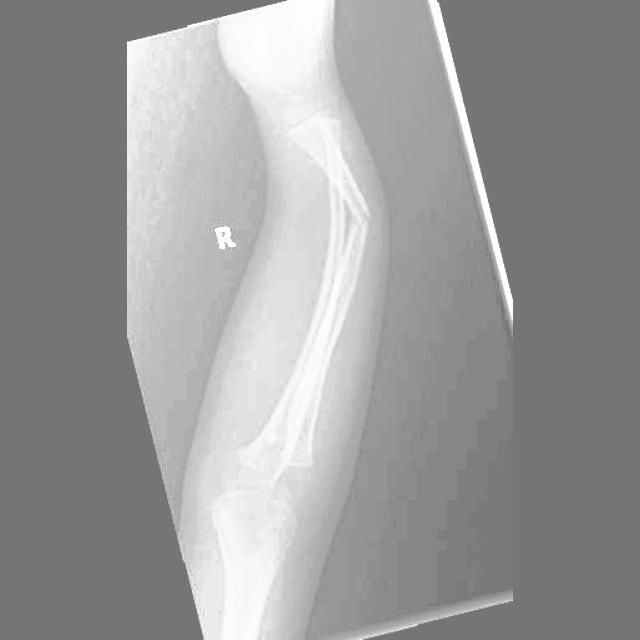 forearmConfidence Object Detection Dataset by Bone fracture detection