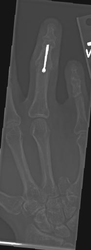 FingerFracture Object Detection Dataset by Bone fracture detection