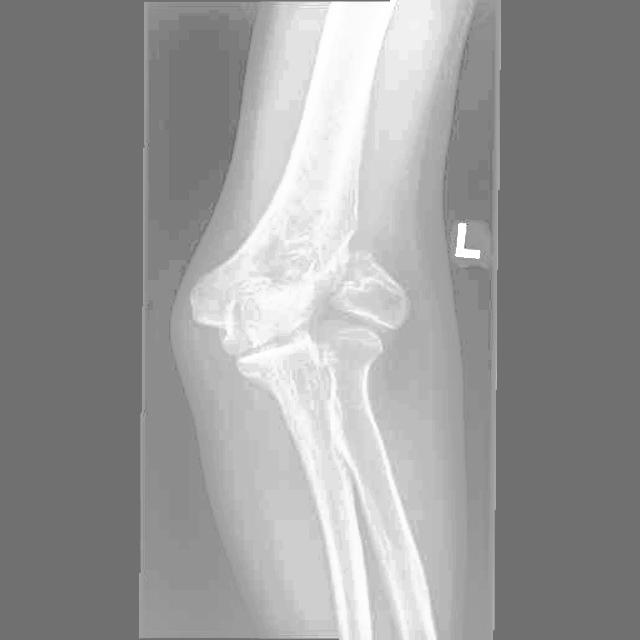 Validdataset 2 Object Detection Dataset By Bone Fracture Detection