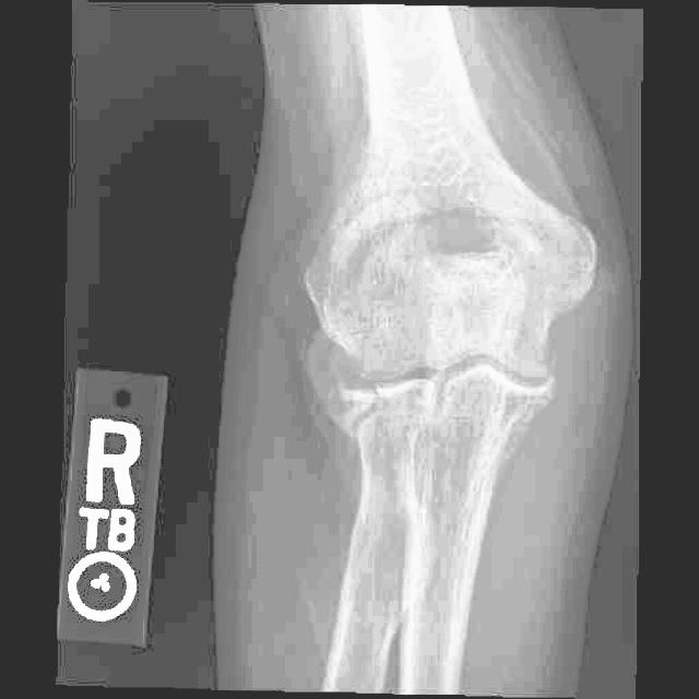 elbowValid Object Detection Dataset by Bone fracture detection